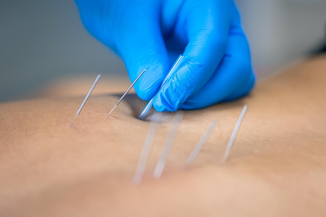 Managing Pain with Acupuncture: What to Expect – AUVON